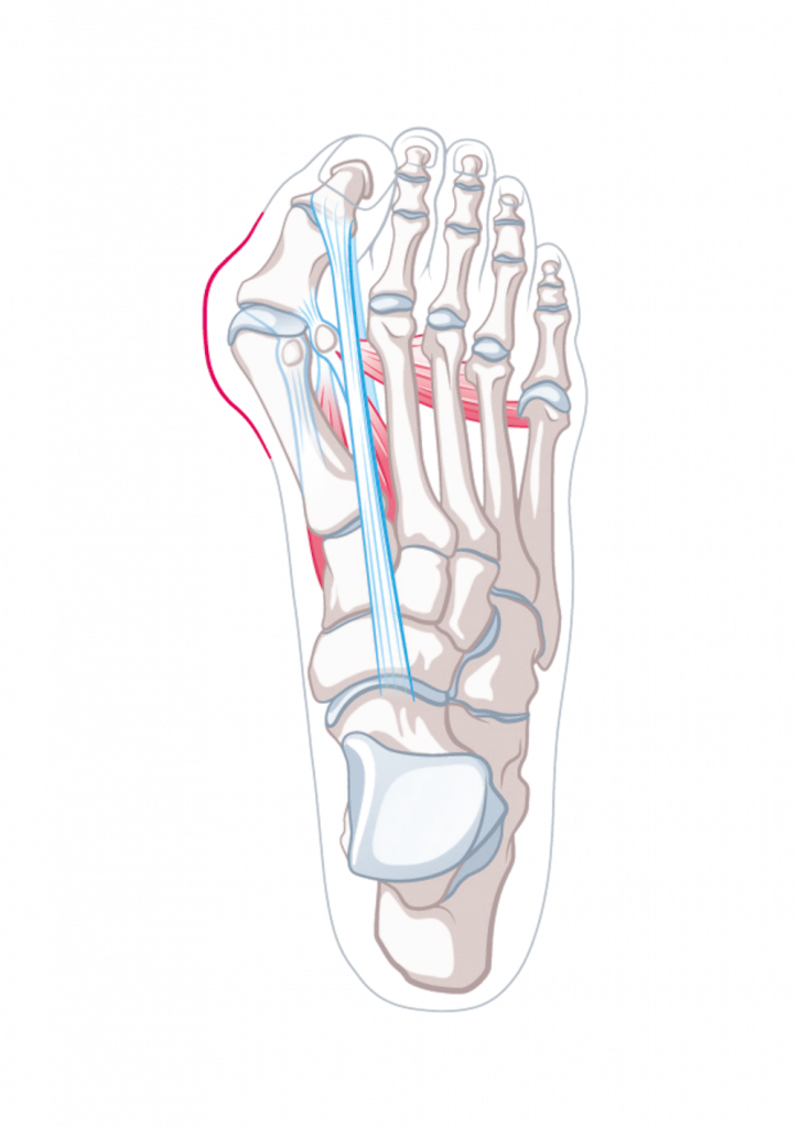 Hallux valgus, Fuss | Gelenkzentrum Zürich, Bethanien