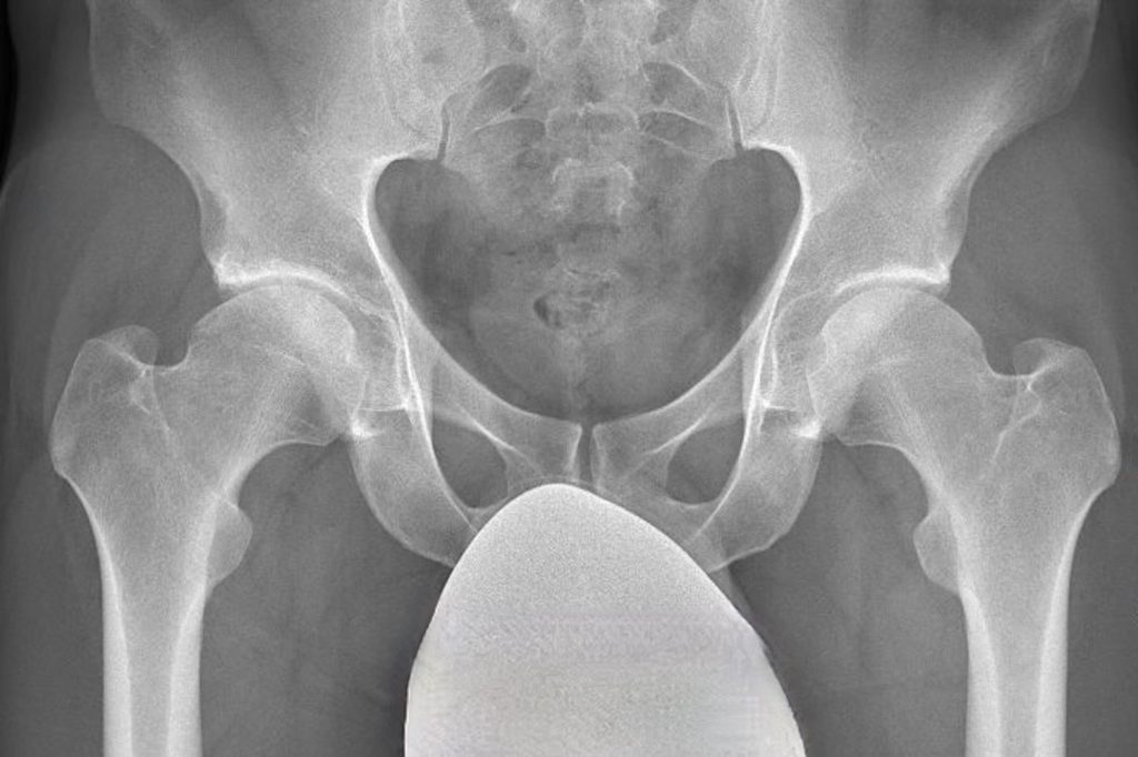 Hüftimpingement (FAIS) | Gelenkzentrum Zürich, Bethanien